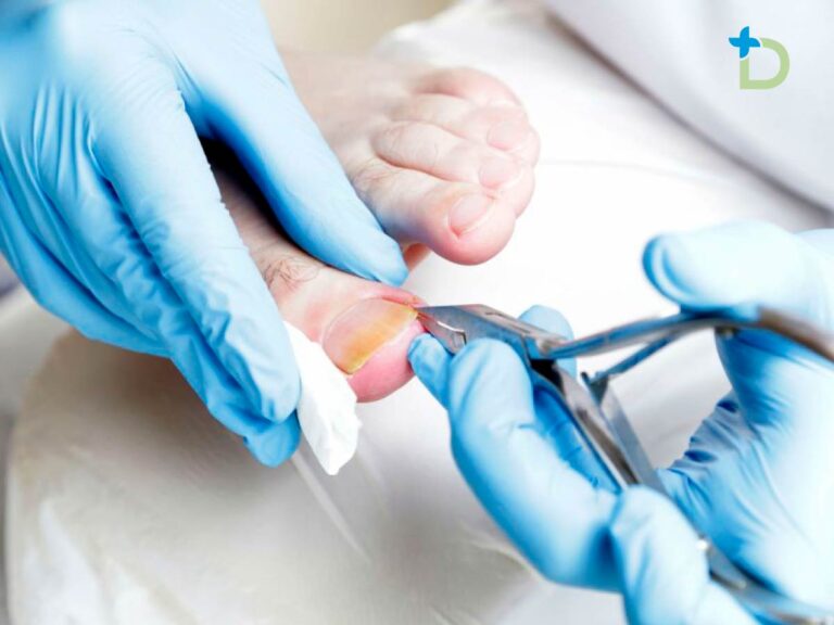 Solución Definitiva para Uñas Encarnadas | Especialistas de la Piel